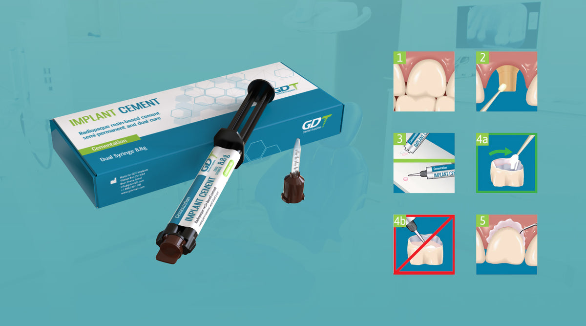 Dental Implant Cementation: Ensuring Crown Longevity with GDT Implant ...