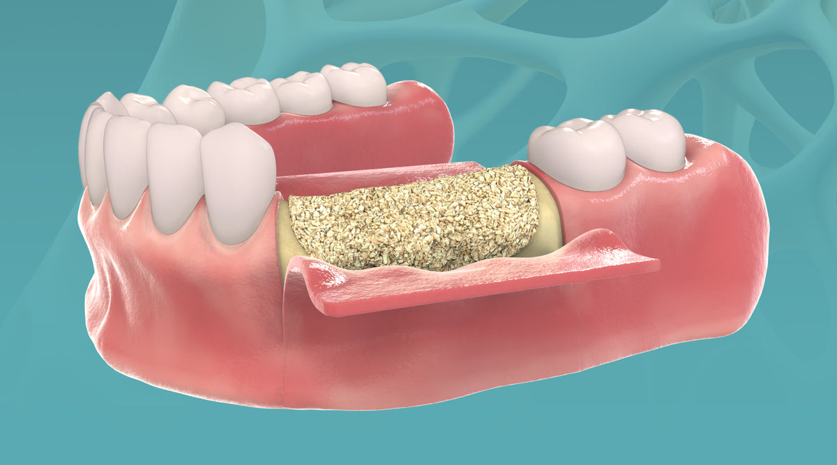 The Advantages of Bovine Bone Graft Granules in Dental Implantology ...